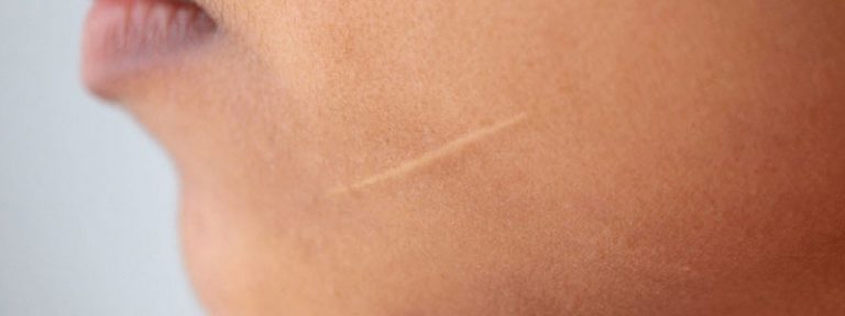 Littekens gezicht - Huidinstituut Skins Only | Schoonheidssalon ...